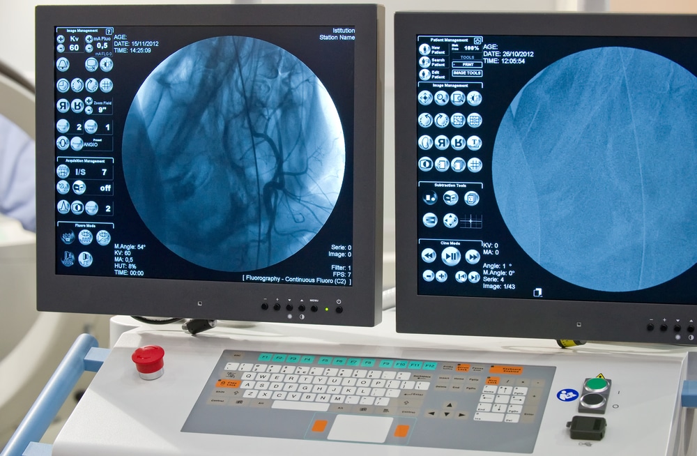 Angiography – computerized blood vessel scanning - MedAssist